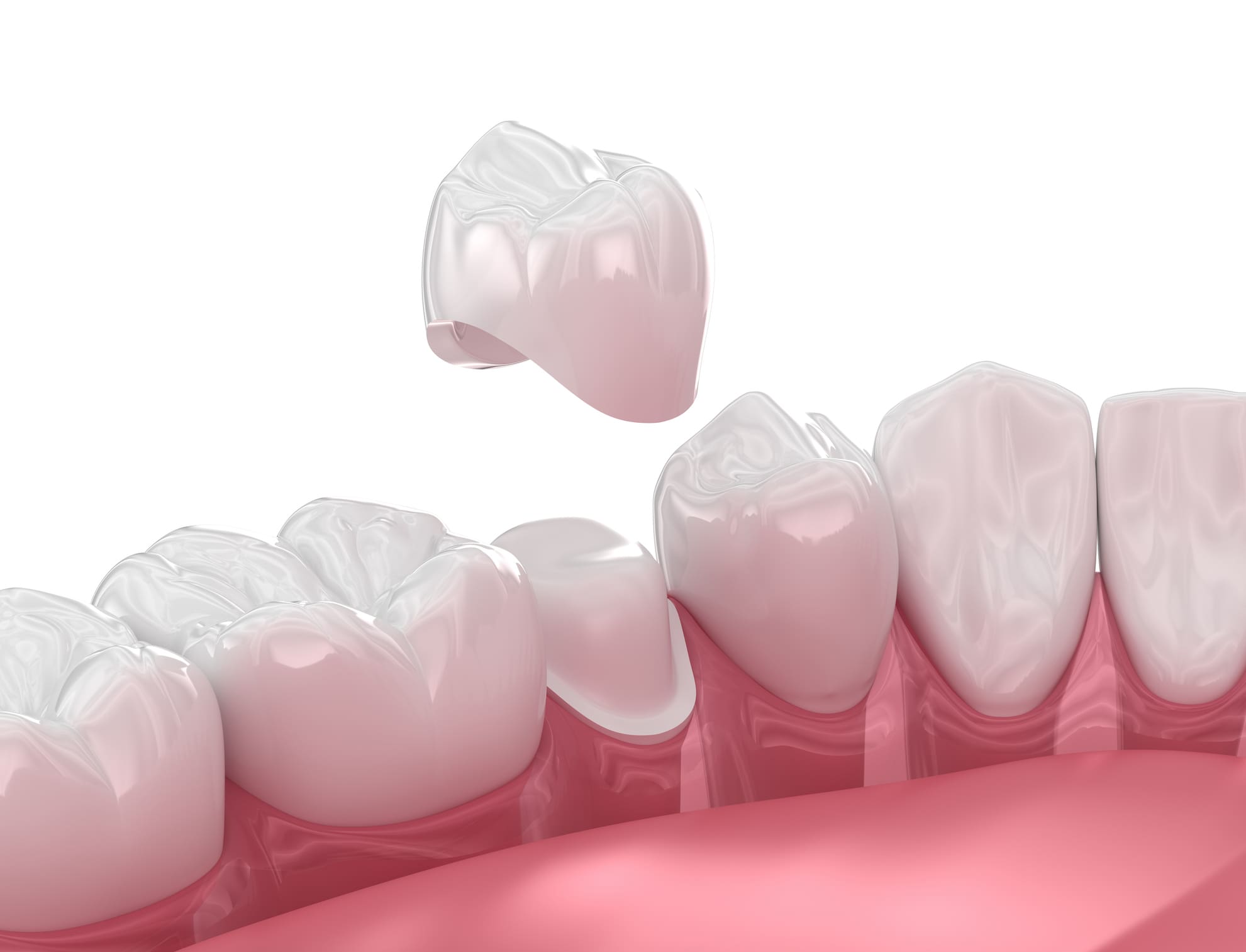 Dental Crown Procedure in Edmonton, AB at Reliance Dental